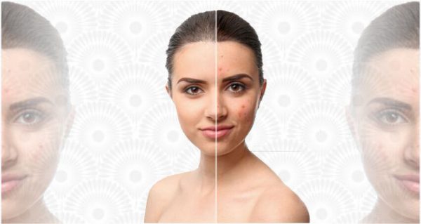 Periorbital Hyper pigmentation (Dark Circles) - Cureka