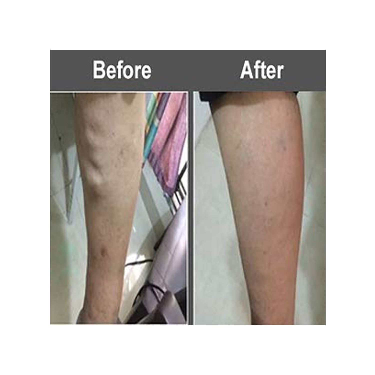 Self Matters Varico Topical Gel for Management of Varicose Veins