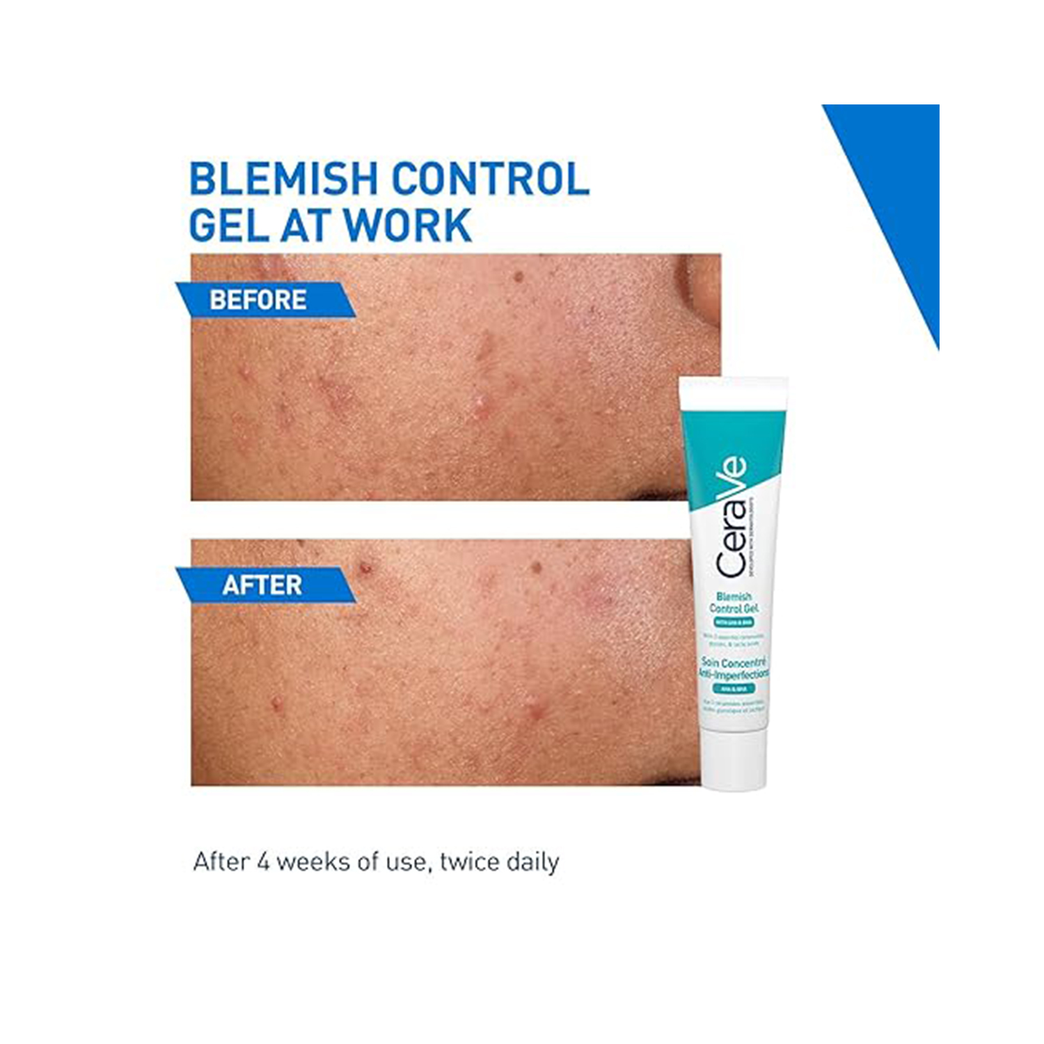 CeraVe Blemish Control Gel (40 ml) - Cureka - Online Health Care ...